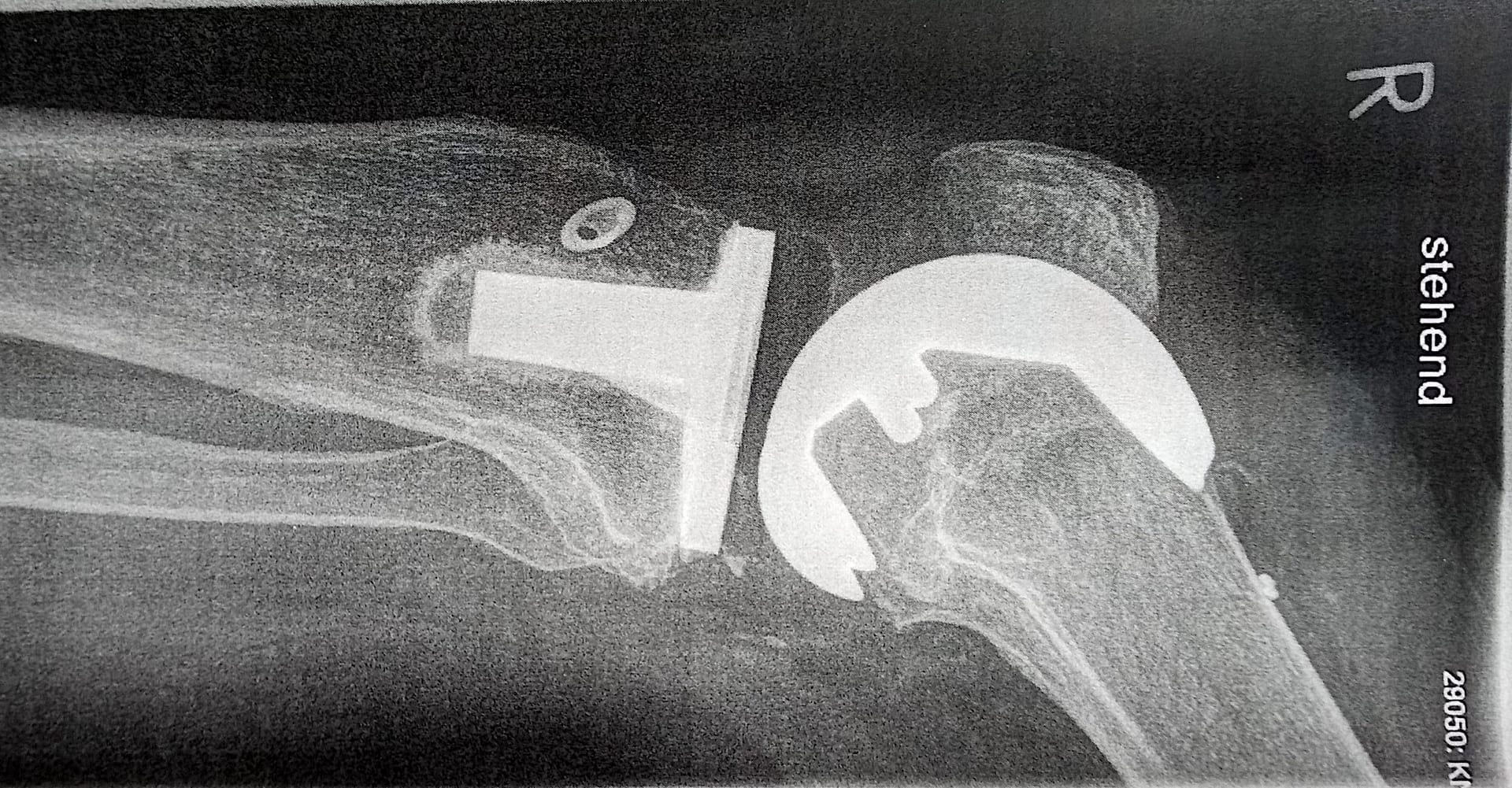 Knie-Prothese: Nach der OP - TOUREN FÜR ÄLTERE